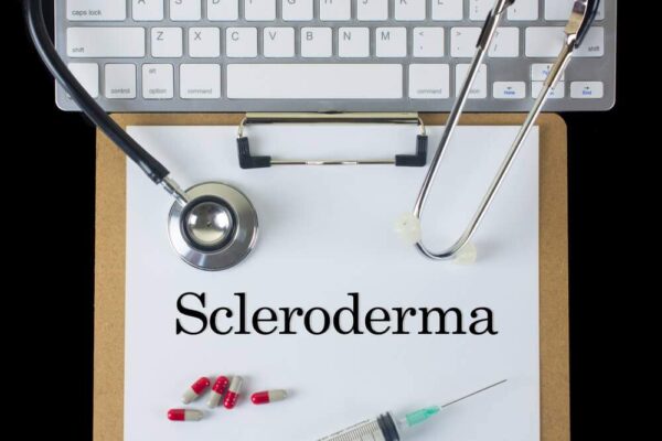 HOW TO TREAT SCLERODERMA NATURALLY IN 30 MINUTES A DAY | Almagia